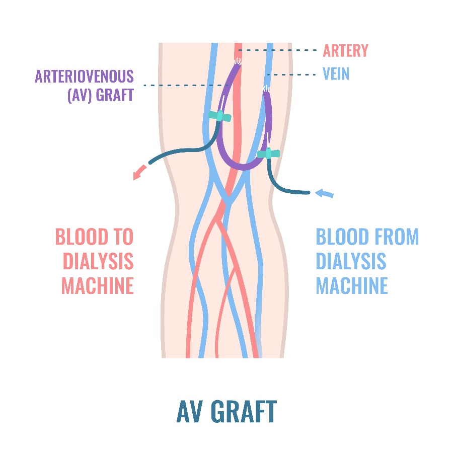 A Game-Changing Solution to Arterio-Venous Access Issues